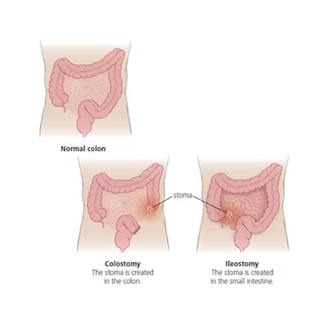 Loop Ileostomy Closure