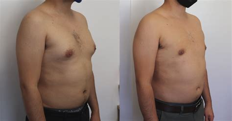 Busting The Myth Targeted Exercises For Man Boobs Anshu Mishras Fitness Guide Theamberpost