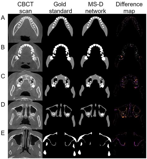 multiclass cbct image segmentation for orthodontics with deep learning h wang j minnema k