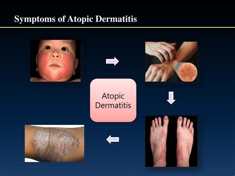 Ppt Causes And Treatment Of Atopic Dermatitis Powerpoint Presentation Id805182