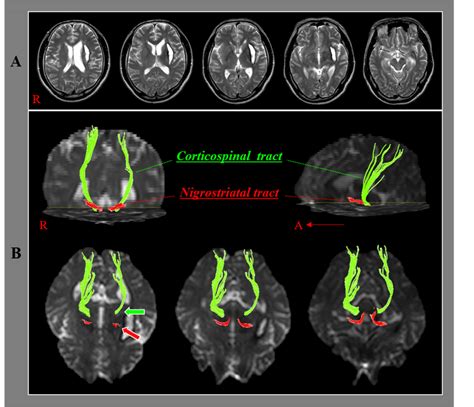 Results Of Diffusion Tensor Tractography For The Nigrostriatal Tract