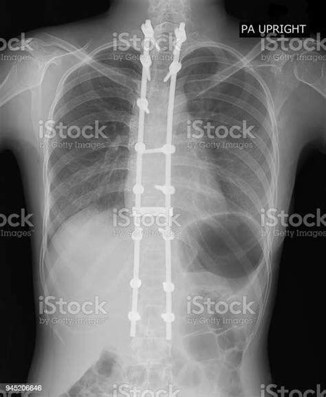 Xray Image Of Adult Patient Spine Show Scoliosis Surgery Fix By Long Metal Rod And Many Screw