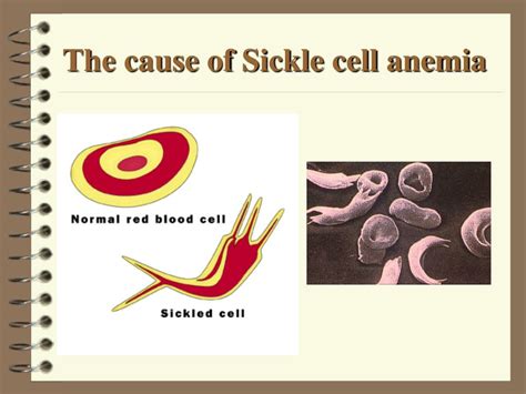 Sickle Cell Anemia Powerpoint