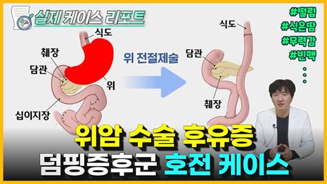 위암 수술 후유증 덤핑증후군 실제 호전 케이스 YouTube