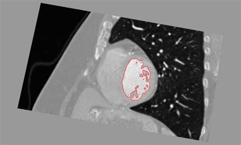 pdf level set segmentation using the hermite transform and the lbps as texture descriptors