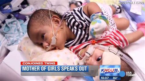 These Tiny Conjoined Twins Need Each Other To Survive