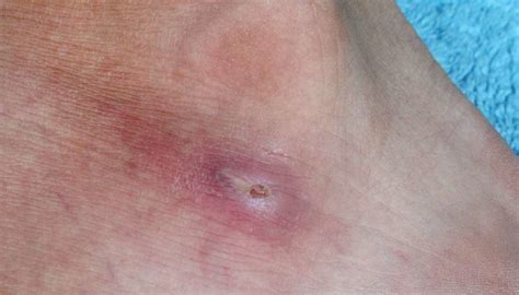 Peds Rash On Bottom Of Feet