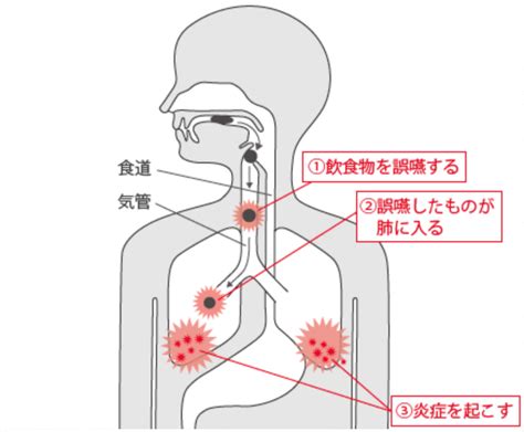 誤嚥性肺炎について 福岡市南区の歯医者「ケンタロウ歯科」