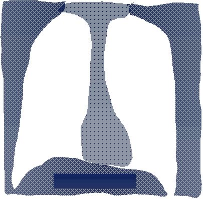 Basic Chest X Ray Interpretation