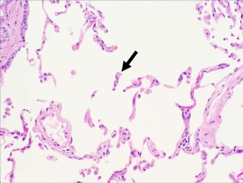 Emphysema Histology Vs Normal