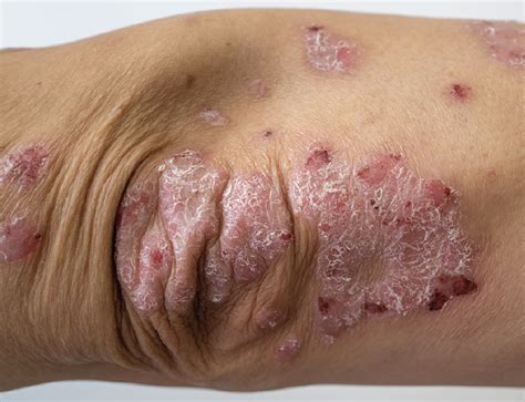 Psoriasis In Sensitive Areas Practical Dermatology