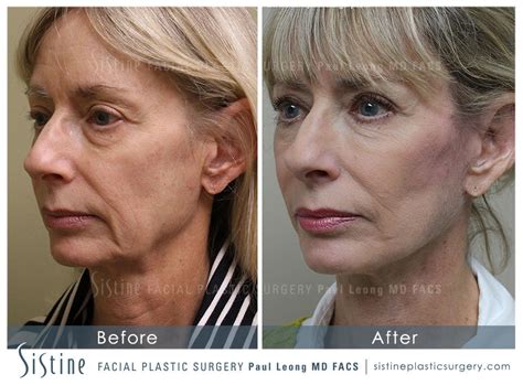 Facelift Before And After 20 Sistine Facial Plastic Surgery