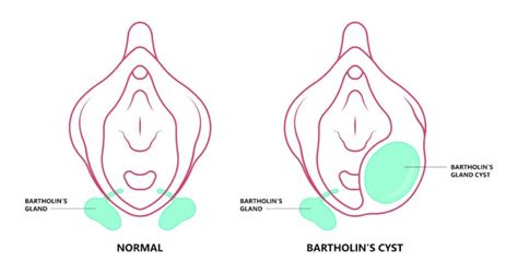 Bartholins Cyst Causes Symptoms And Removal Andrew Krinsky Md Facog