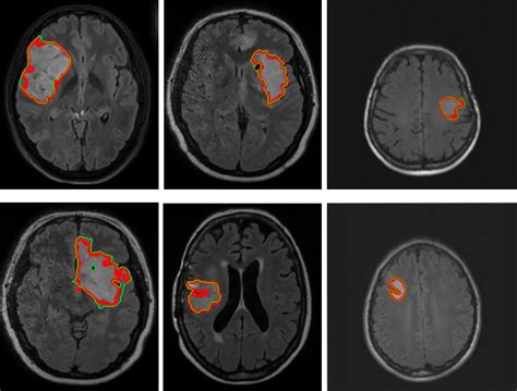 segmentation of brain tumors from mri using adaptive thresholding and graph cut algorithm