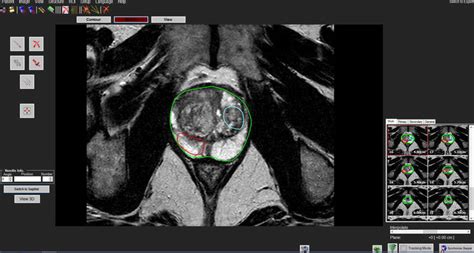 The Role Of Mri Trus Fusion Biopsy In The Diagnosis Of Clinical Significant Prostate Cancer