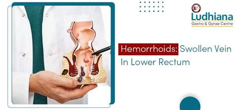 Hemorrhoids Symptoms Causes Diagnosis And Treatment