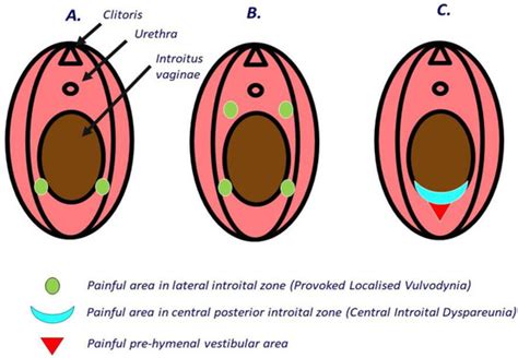 Jcm Free Full Text Long Term Outcome Of Surgical Treatment Of Central Introital Dyspareunia