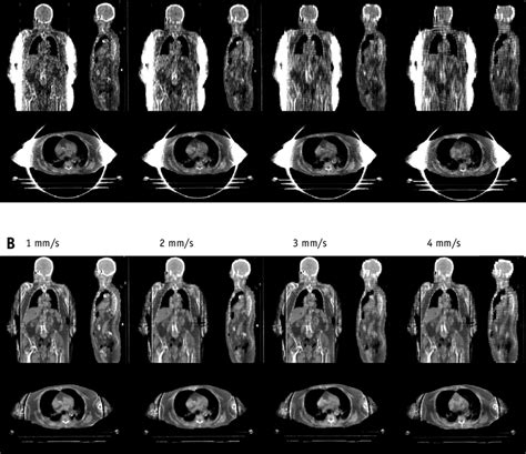 megavoltage computed tomographic images reconstructed with a the download scientific diagram