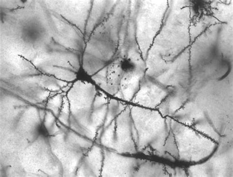 Category Diseases And Disorders Of The Nervous System Wikimedia Commons