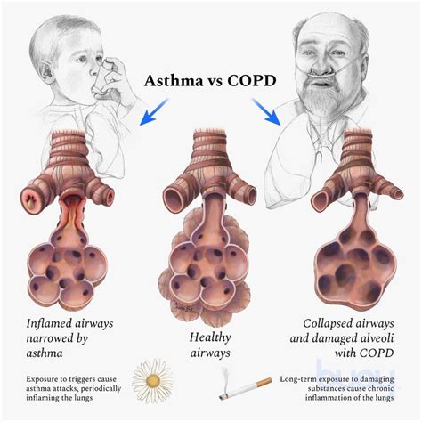 Both Asthma And COPD Are Respiratory Diseases But They Are Different