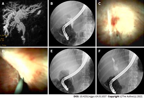 digital single operator cholangioscopy for biliary stricture after cadaveric liver transplantation