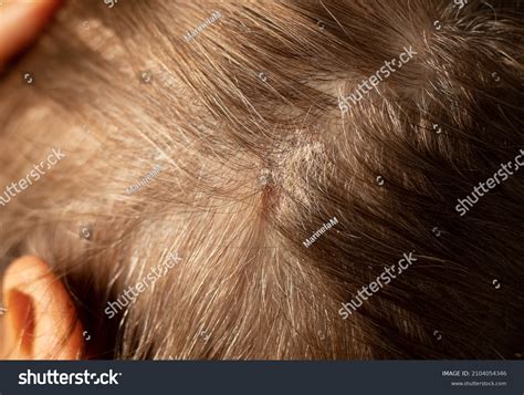 Scalp Scabs Causes And How To Treat Them