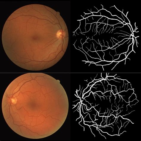 Retinal Vessel Segmentation Using PyTorch Semantic Segmentation