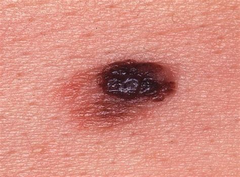 Melanoma Skin Cancer On Moles