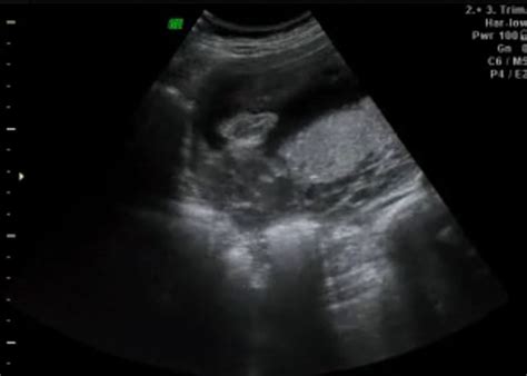 Ambiguous Genitalia Ultrasound