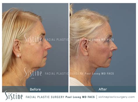 Deep Neck Lift Before And After 01 Sistine Facial Plastic Surgery