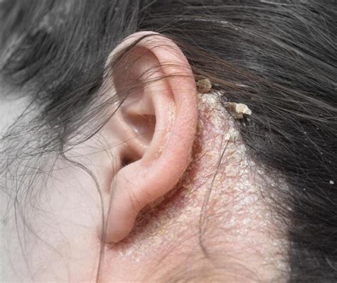 The 3 Most Common Scalp Diseases • Dr Piotr Turkowski