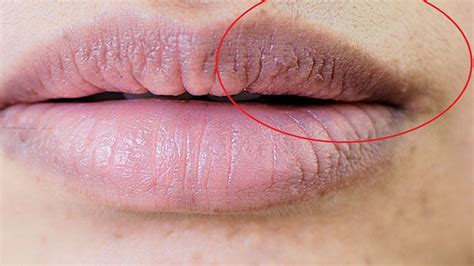 How To Get Rid Of Hyperpigmentation Around Lips YouTube