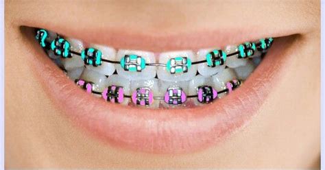 Braces Colors That Look Good Together