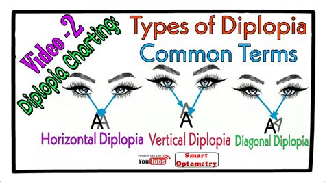 Types Of Diplopia Common Terms Diploma Charting Video 2 YouTube