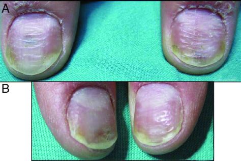A Matrix And Bed Nail Psoriasis Before Treatment B After Four Download Scientific Diagram