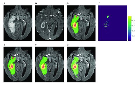 an example of brain tumor segmentation result and the associated download scientific diagram