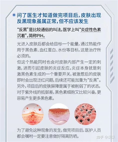 采美科普光电项目后返黑怎么办别慌UFACE优斐斯带你做好项目后损伤修护 知乎
