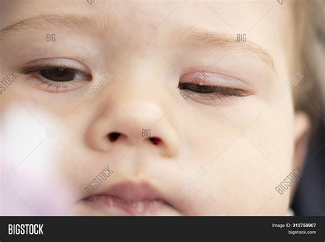 White Bump On Eyelid Eyelid Bumps 101 How To Identify Styes Milia Pimples Allure When This