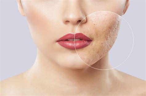 What Are The Best Products For Acne Scars Euroburn Doctors Federation