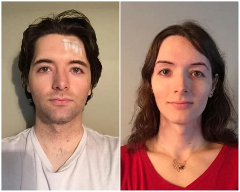 Mtf Yr Hrt Yo In Week Bottom Surgery In Day