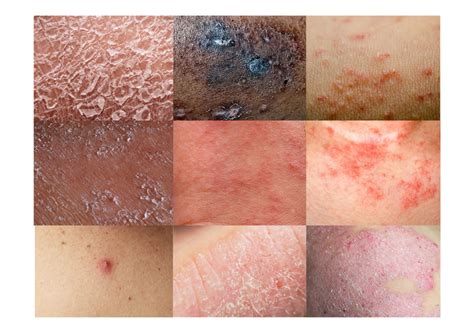 Different Types Of Eczema P2 And You