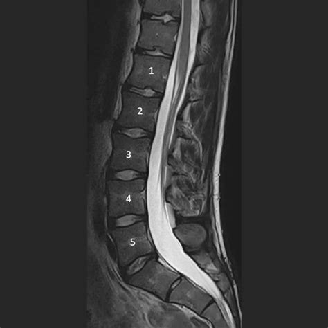 Mrt Wirbelsäule Hws Bws And Lws Aristra Radiologie Netzwerk