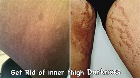 Why Is The Skin On My Thighs Burning At Fred Winfield Blog