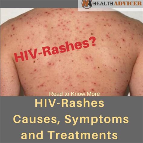 Hiv Rash Start