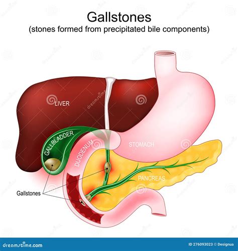 Gallstones Parts Of A Digestive System Gallbladder Duodenum Stomach