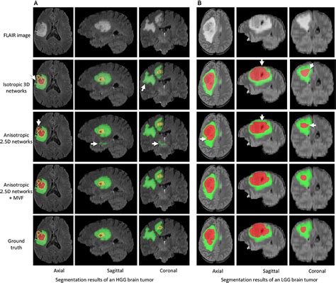 frontiers automatic brain tumor segmentation based on cascaded convolutional neural networks