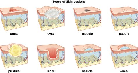 Types Of Skin Lesions Chart