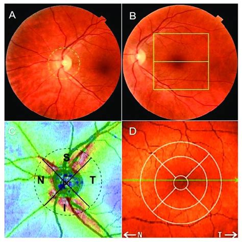 Spectral Domain Optical Coherence Tomography SD OCT Report Of The