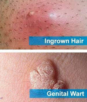 Ingrown Hair Or STD Pimple Wart Staph Spider Bite Skin Cancer