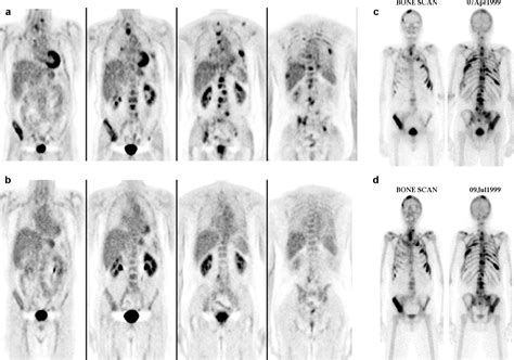 New Horizons In Prostate Cancer Imaging European Journal Of Radiology